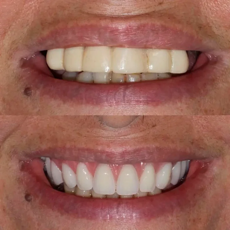 Prótese Fixa - ortoesteticaboaviagem.com.br